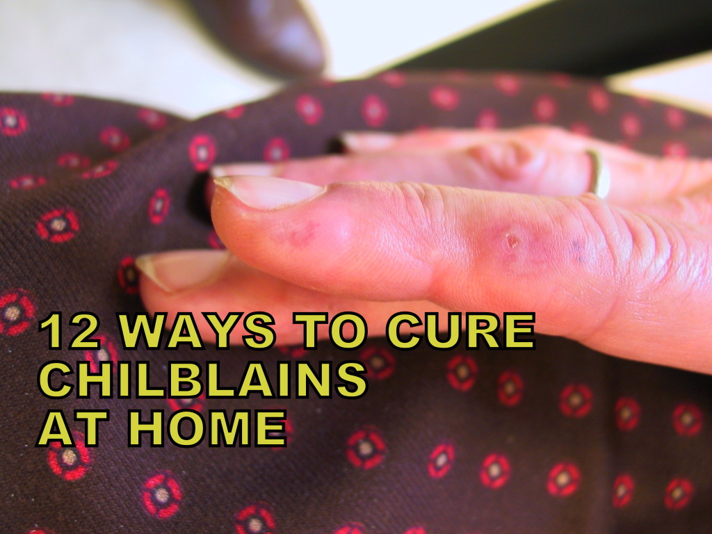 12 Simple Chilblain Treatments; Natural & Homemade