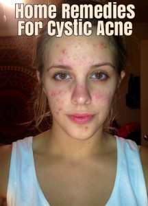 How To Get Rid of Cystic Acne? Cystic Pimples Treatment at Home