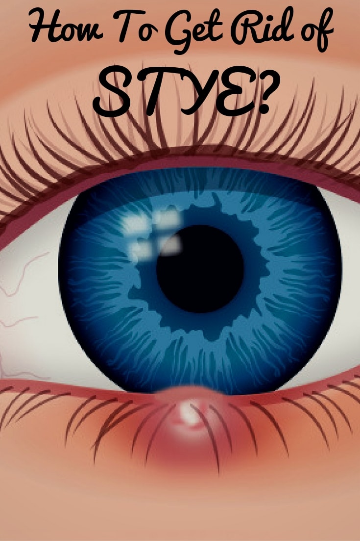 How to Get Rid of Stye? Home Remedies for Stye Treatment