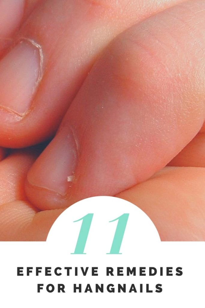 How to Get Rid of Hangnails? How To Treat Hangnails?