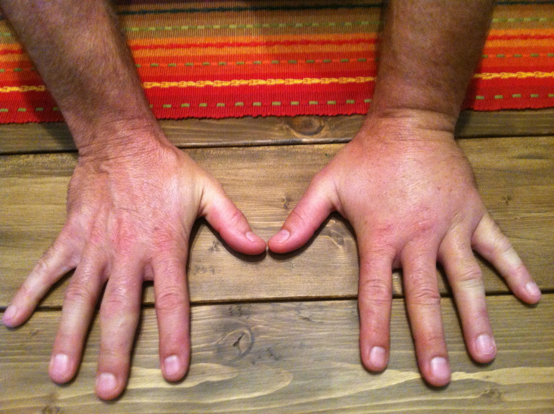 7 Home Remedies for Yellow Jacket Stings Gathered from Your Kitchen