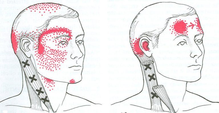 How To Get Rid Of Tension Headaches With Home Remedies 10 Easy Methods